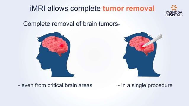 Intraoperative MRI (iMRI) for Brain Surgery in Hyderabad | PPT