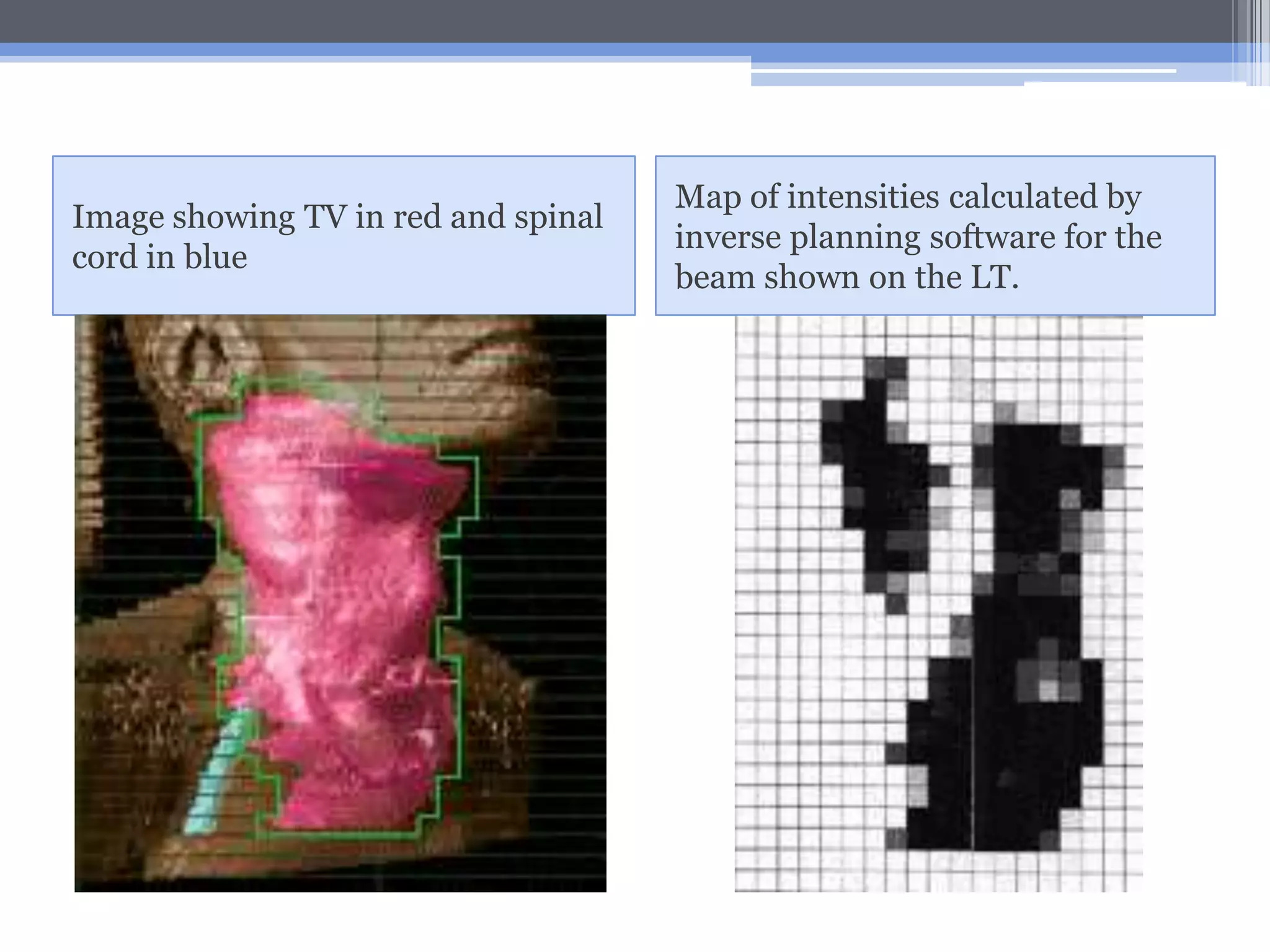 IMRT: Intensity Modulated Radiotherapy | PPTX
