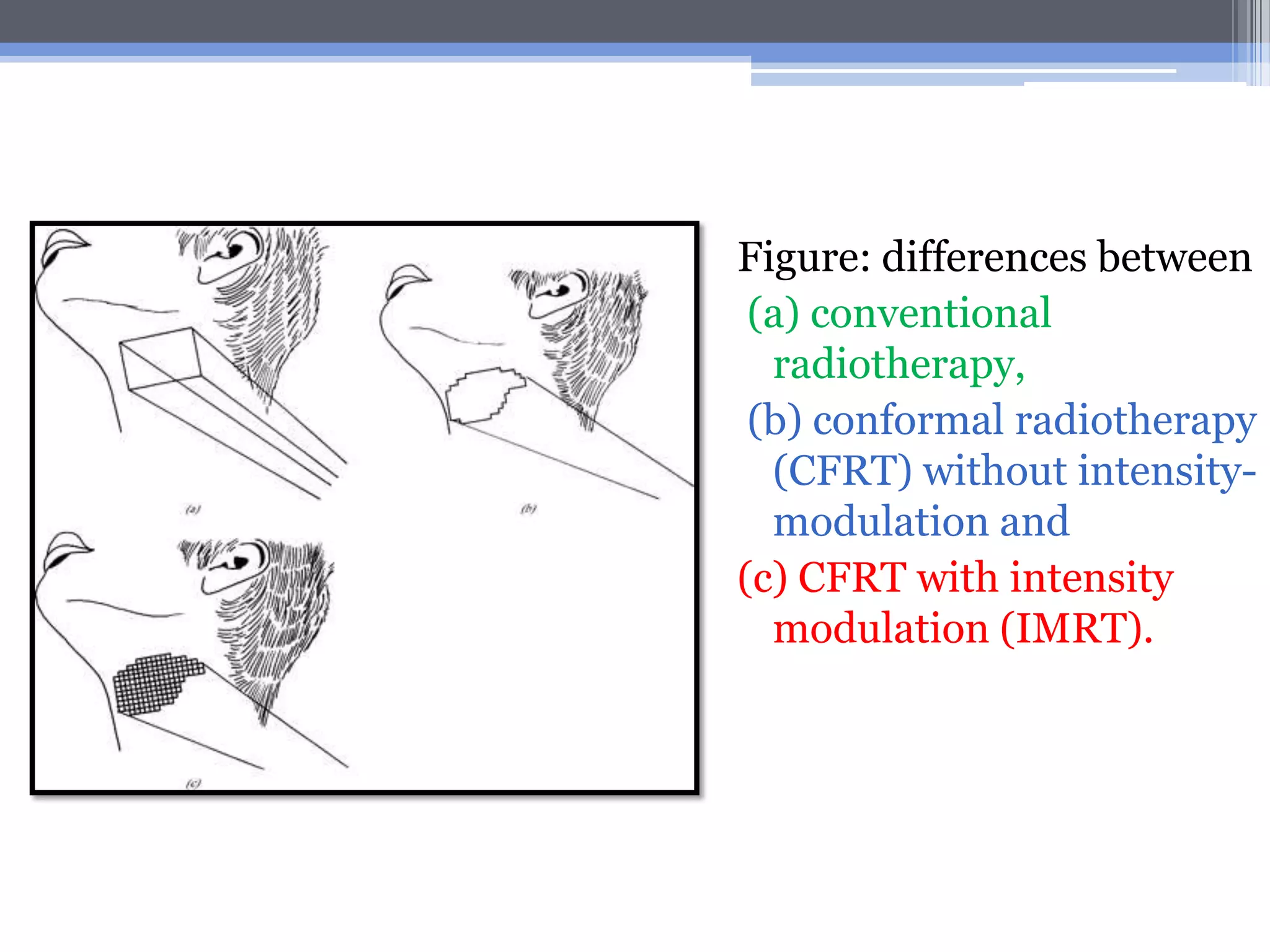 IMRT: Intensity Modulated Radiotherapy | PPTX