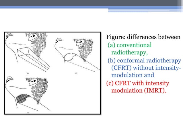 IMRT: Intensity Modulated Radiotherapy | PPTX | Cancer | Diseases and ...