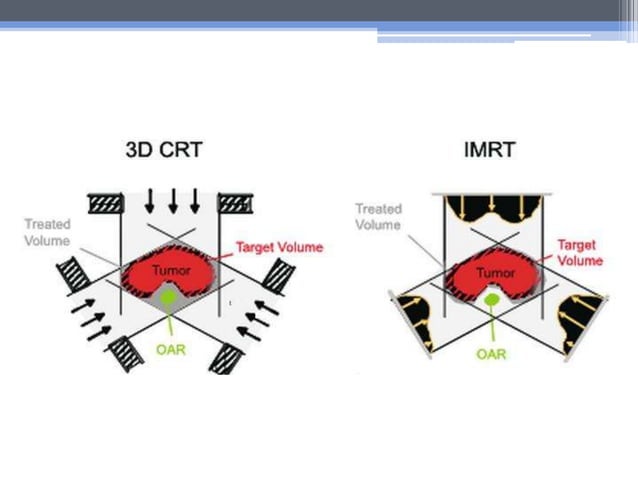 IMRT: Intensity Modulated Radiotherapy | PPT