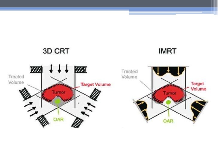 IMRT: Intensity Modulated Radiotherapy