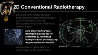 Intensity Modulated Radiation Therapy (IMRT) | PDF