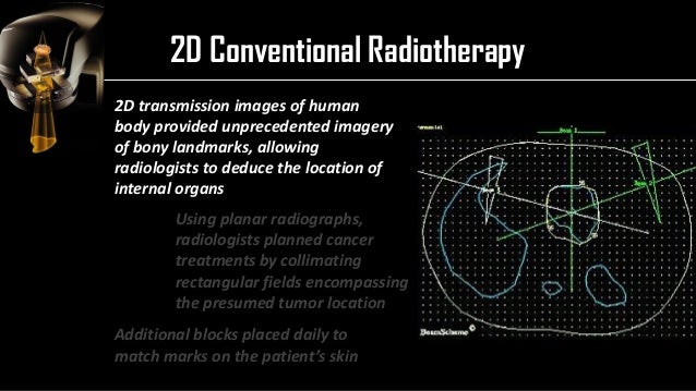 Intensity Modulated Radiation Therapy (IMRT)