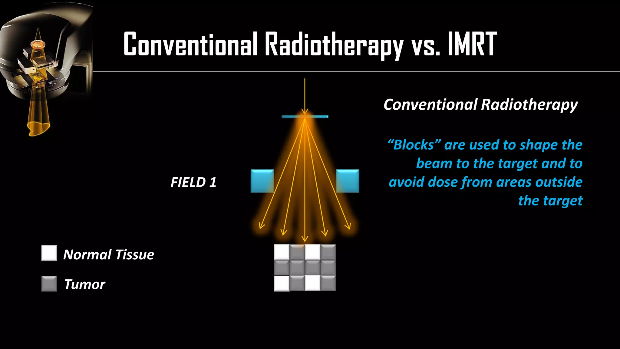 Intensity Modulated Radiation Therapy (IMRT) | PDF