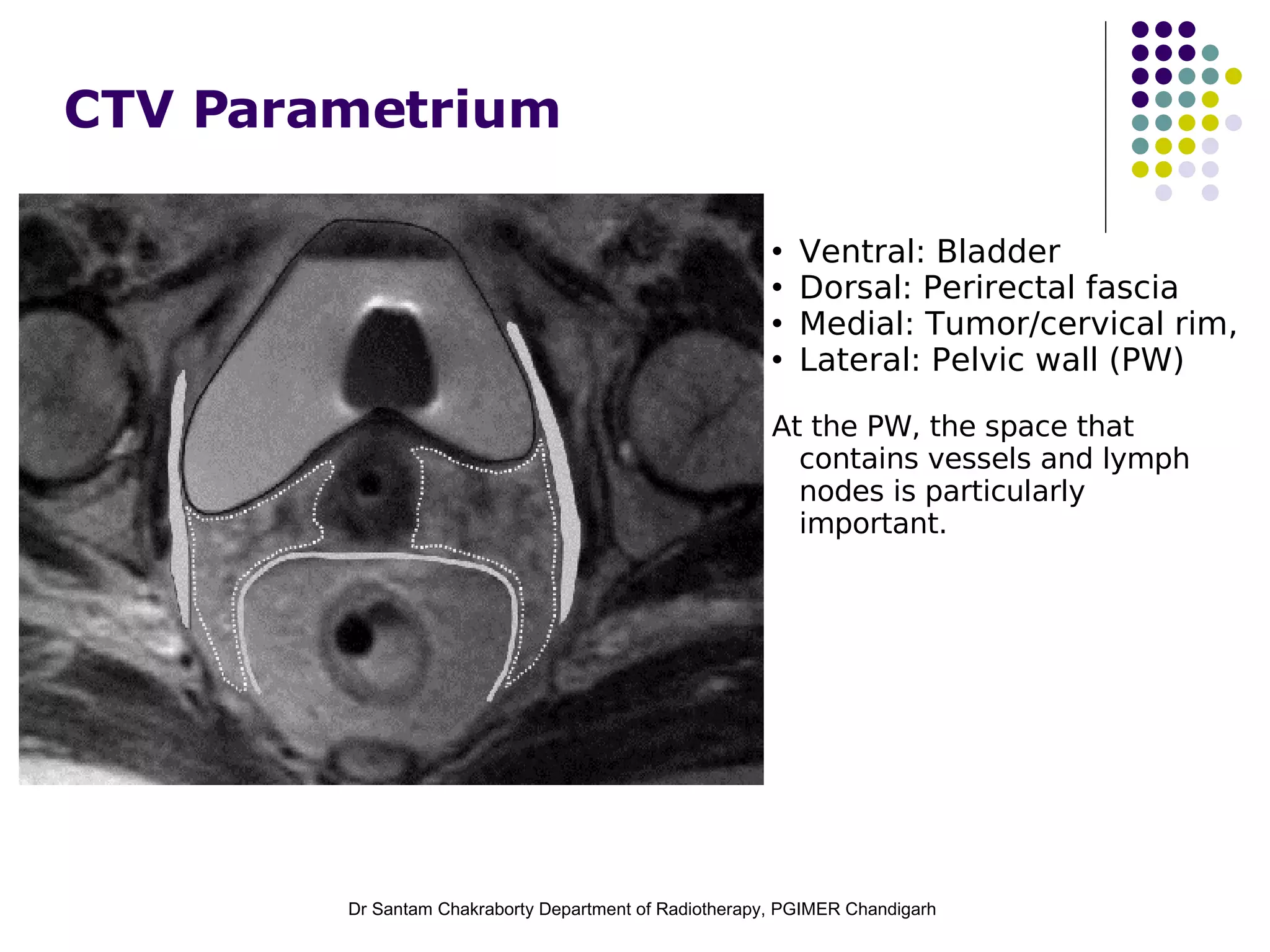 IMRT and 3D CRT in cervical Cancers | ODP