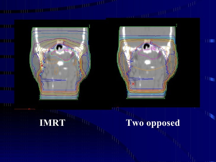 Imrt A New Treatment Method For Nasopharyngeal Cancer