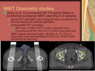 Imrt For Anal Cancer | PPT