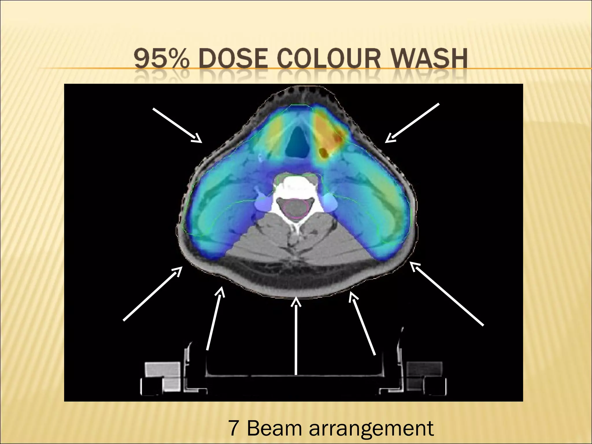 IMRT in Head & Neck Cancer | PPT
