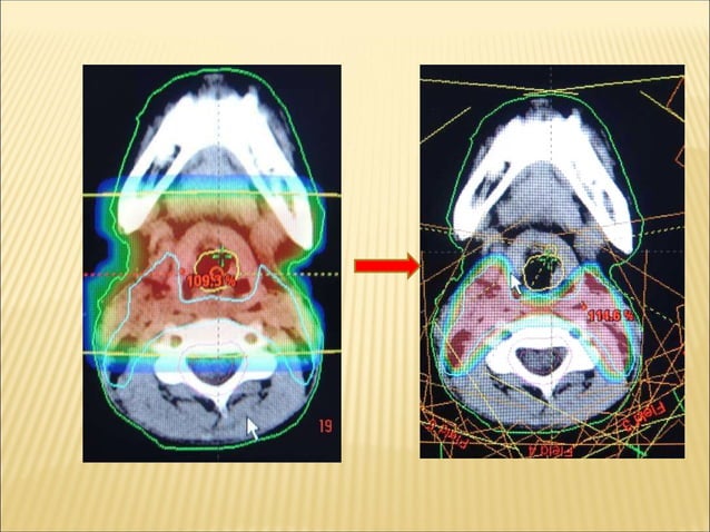 IMRT in Head & Neck Cancer | PPT