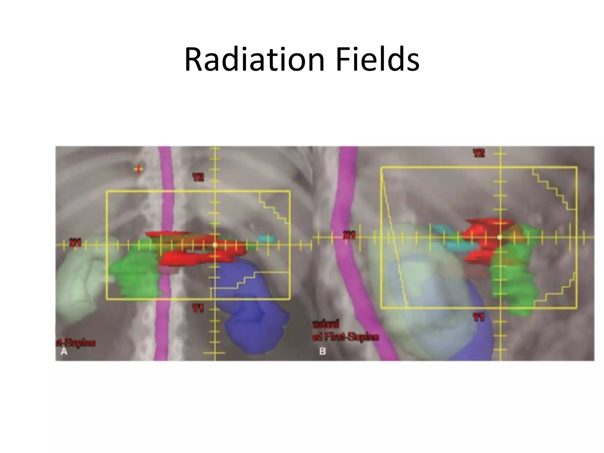 IMRT in pancreas | PPT