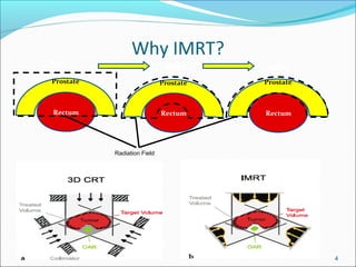 introduction to Intensity modulated radiation therapy | PPT
