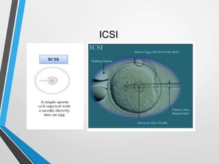 INTRACYTOPLASMIC MORPHOLOGICALLY SELECTED SPERM INJECTION (IMSI).pptx