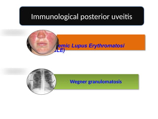 auto immune diseases associated uveitis.pptx