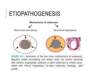IN STENT RESTENOSIS | PPTX