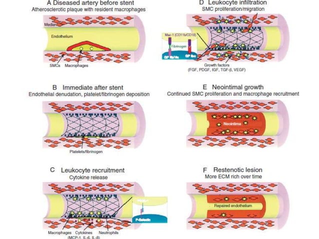 IN STENT RESTENOSIS | PPTX | Heart and Cardiovascular Diseases ...