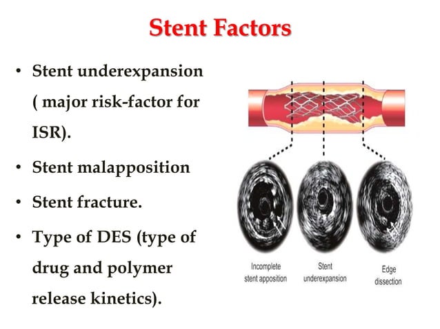 In stent restenosis | PPTX