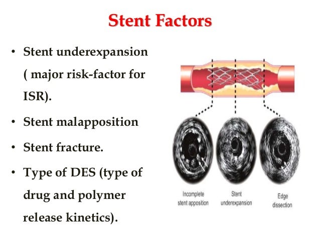 In stent restenosis