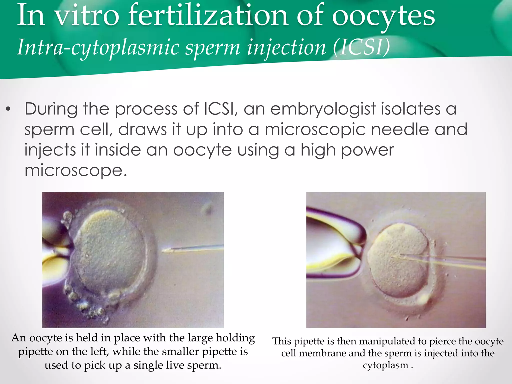In vitro fertilization | PPTX
