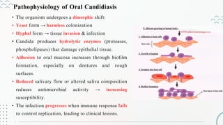 Over veiw of Oral Candidal infections.pdf