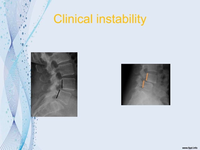 Incapacitating spinal instability | PPTX