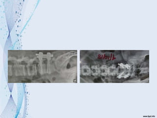 Incapacitating spinal instability | PPTX