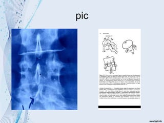 Incapacitating spinal instability | PPTX