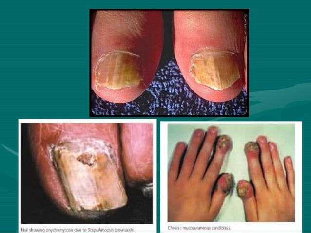 dermatophytes infections