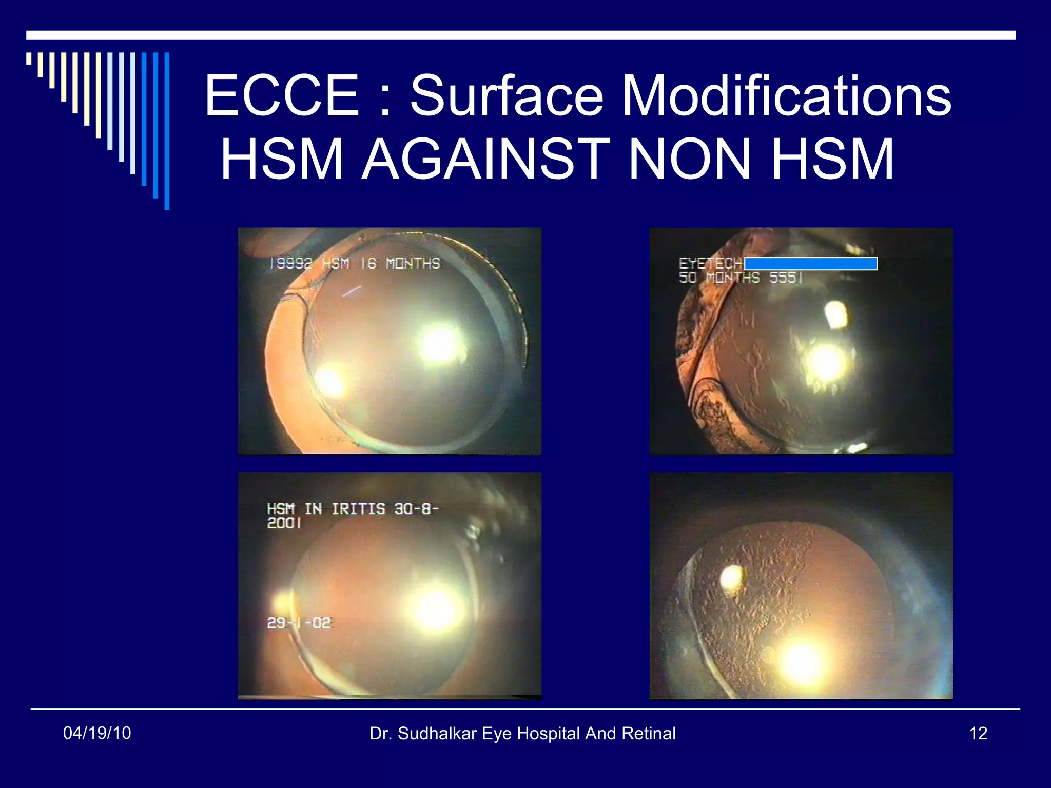 Incidence of posterior capsular opacification in rigid pmma | PPT