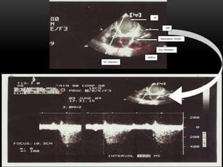 Incidental cor triatriatum sinister with congenital mr in | PPTX