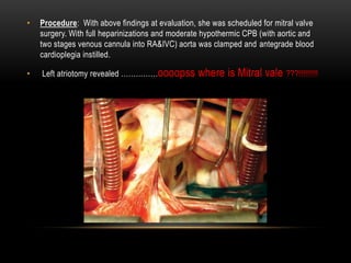 Incidental cor triatriatum sinister with congenital mr in | PPTX