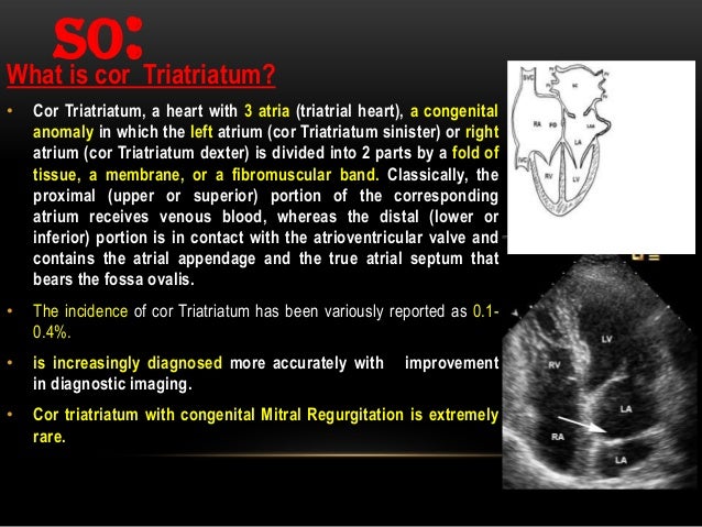 Incidental cor triatriatum sinister with congenital mr in