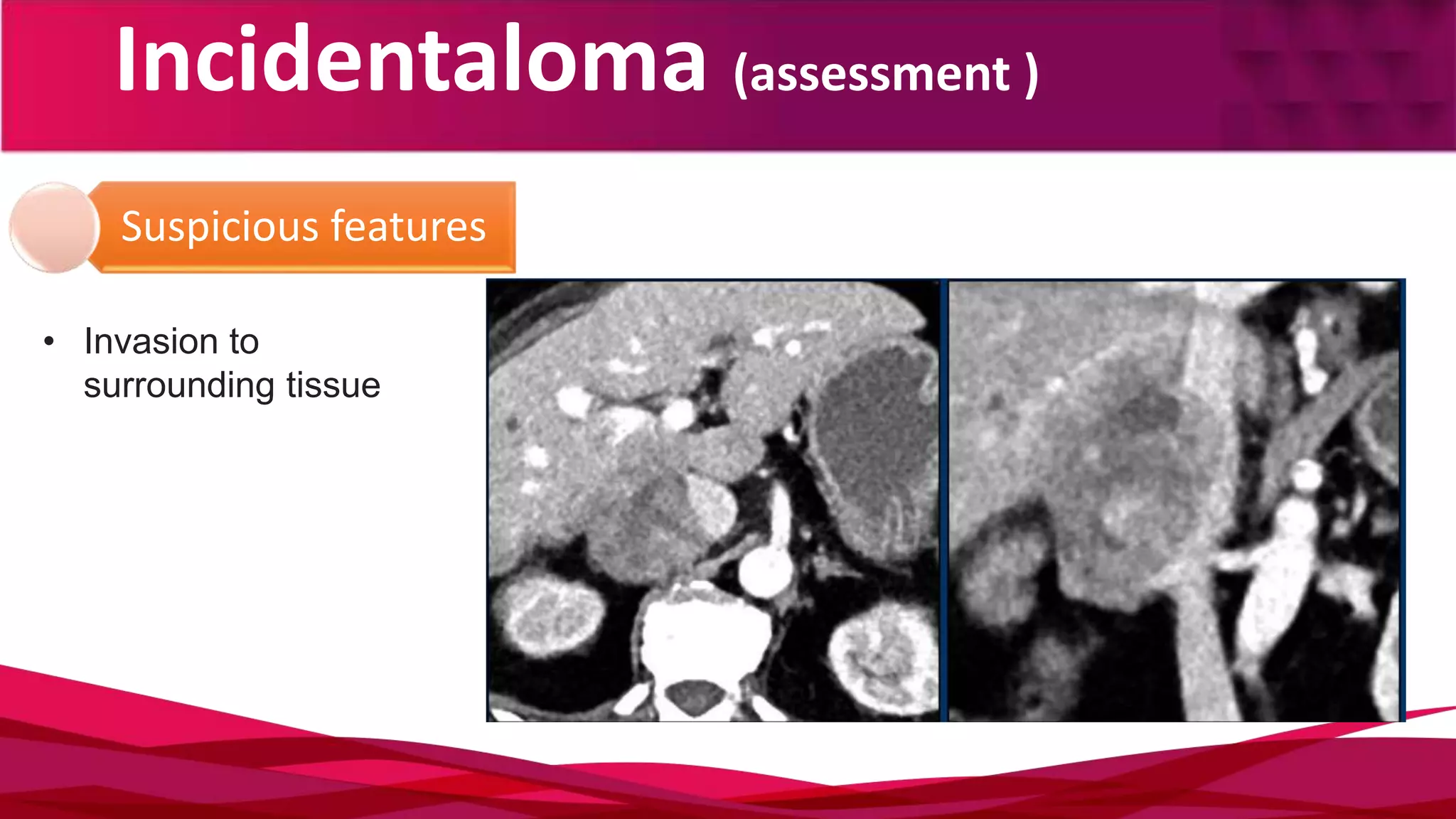 Incidentaloma Dr. Khaled.pptx | Endocrine and Metabolic Diseases ...