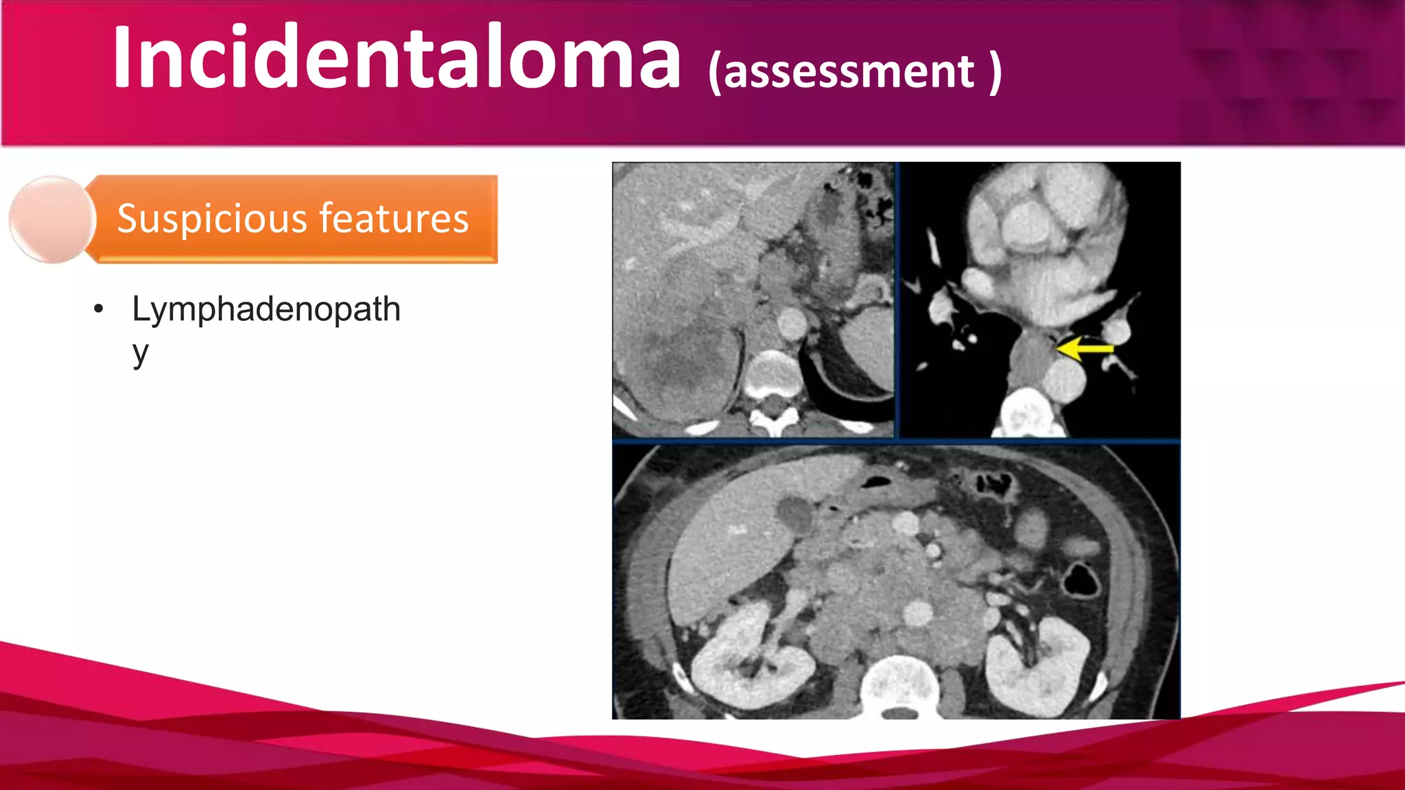 Incidentaloma Dr. Khaled.pptx | Endocrine and Metabolic Diseases ...