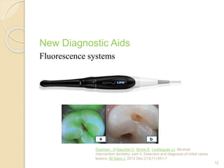 Incipient caries | PPT