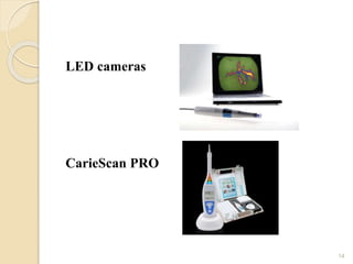 Incipient caries | PPTX