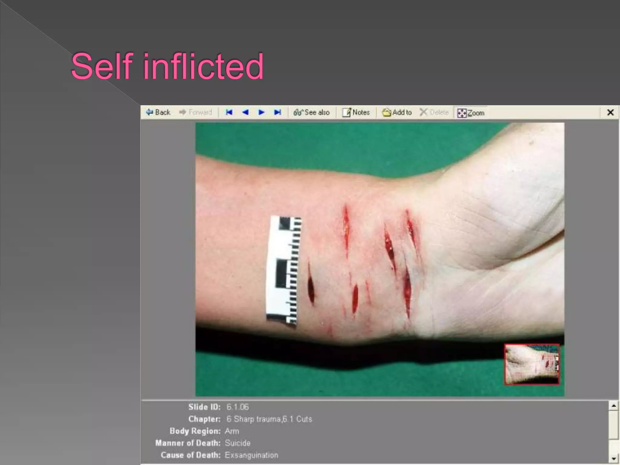 Incised wounds by Dr.M Balaji singh, ACSMCH, Chennai 2020 | PPTX