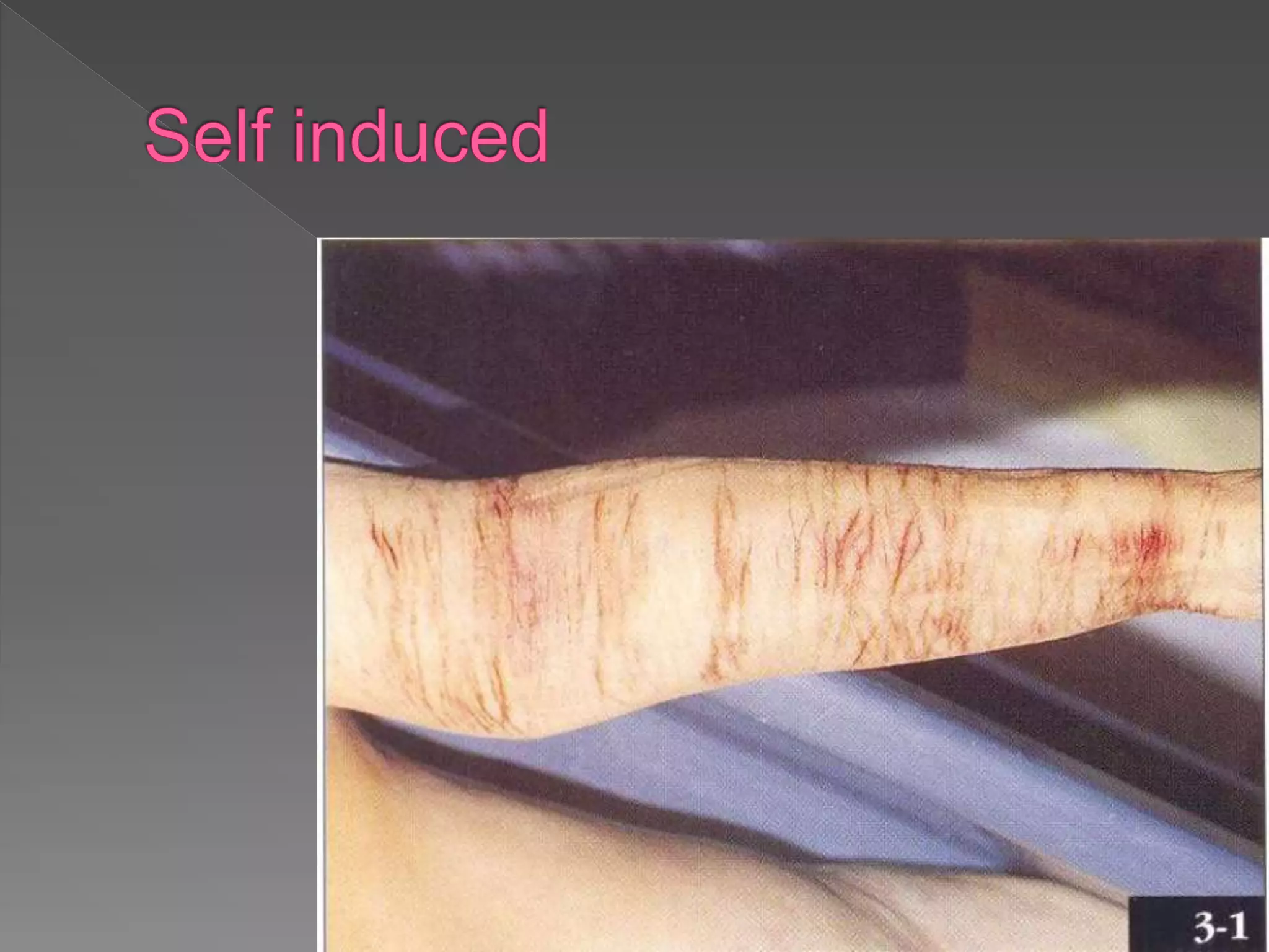 Incised wounds by Dr.M Balaji singh, ACSMCH, Chennai 2020 | PPTX