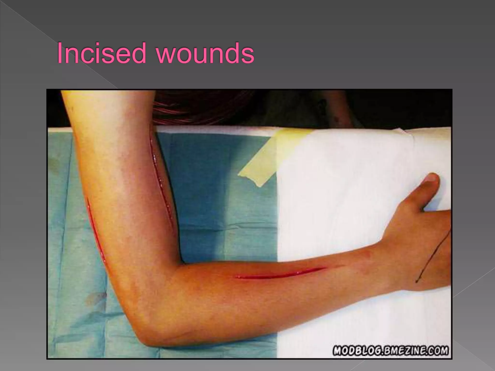 Incised wounds by Dr.M Balaji singh, ACSMCH, Chennai 2020 | PPTX