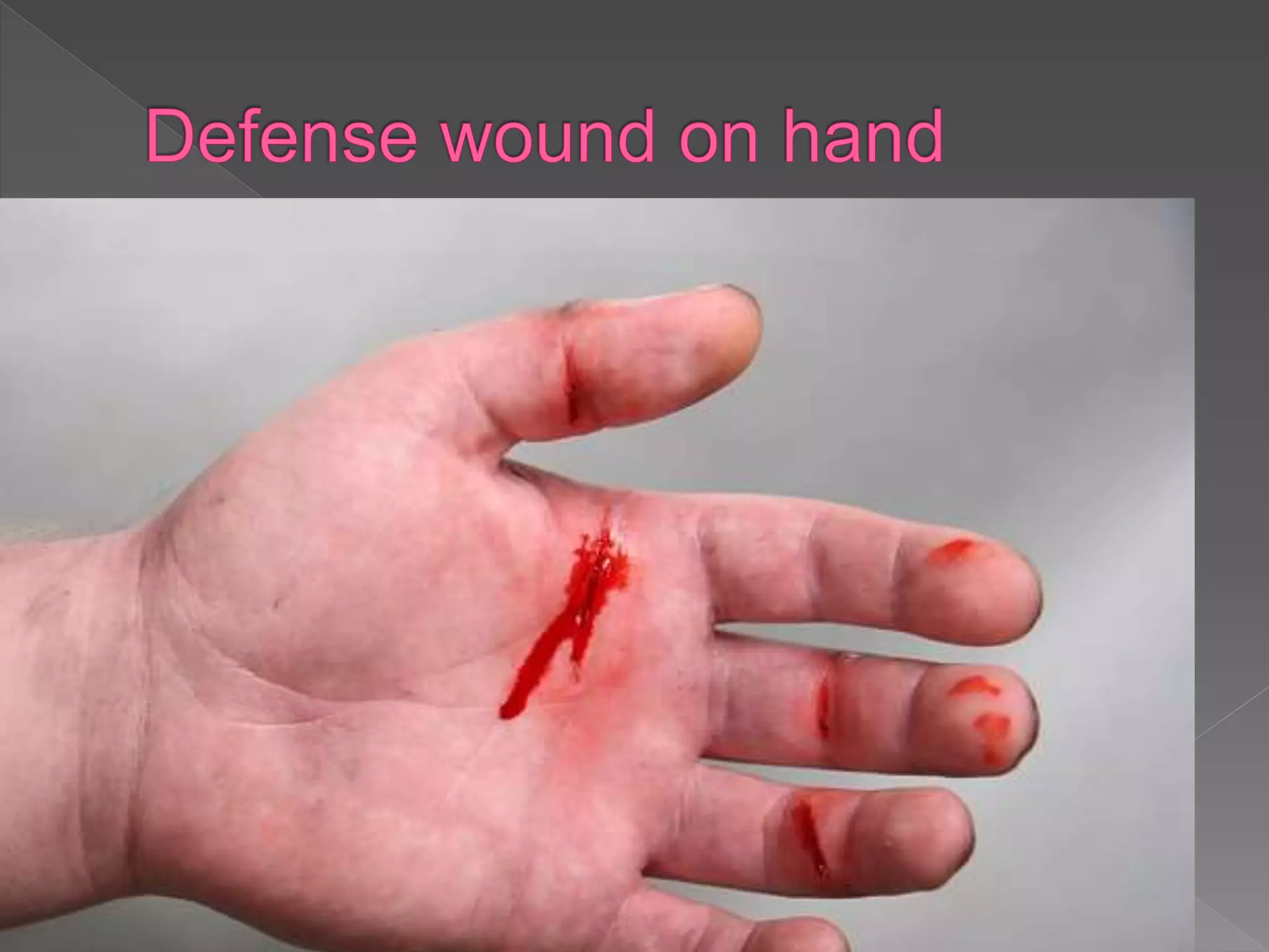 Incised wounds by Dr.M Balaji singh, ACSMCH, Chennai 2020 | PPTX