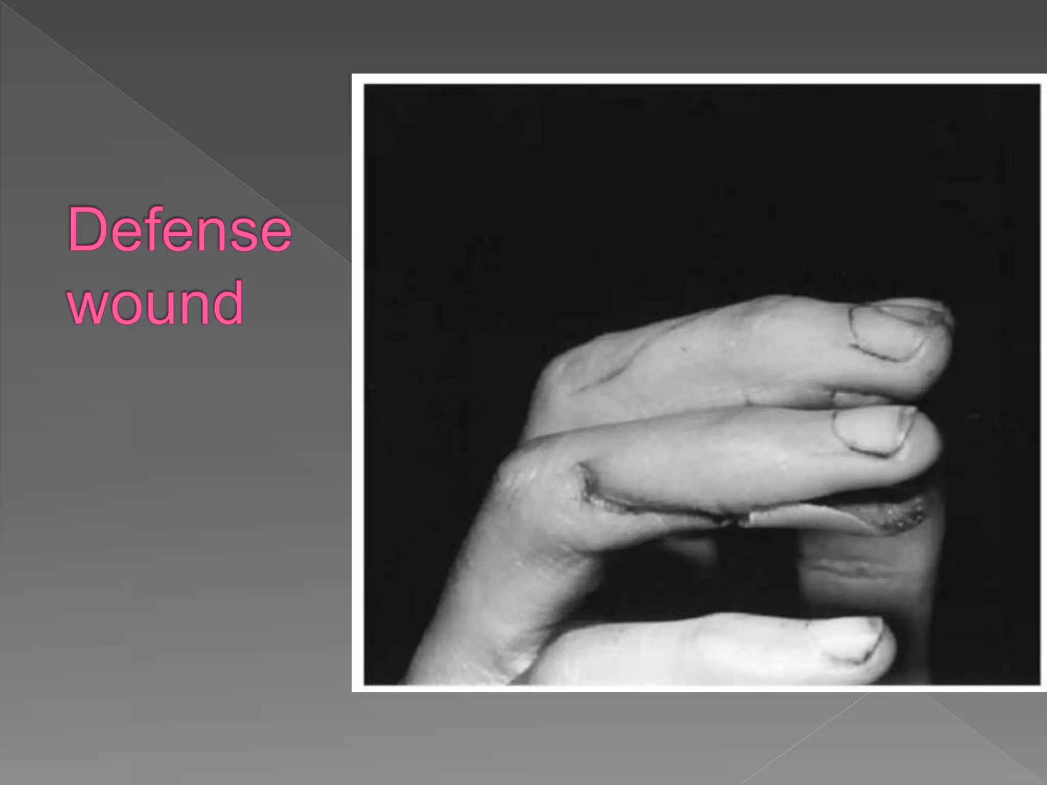 Incised wounds by Dr.M Balaji singh, ACSMCH, Chennai 2020 | PPTX