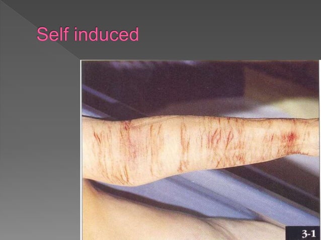 Incised wounds by Dr.M Balaji singh, ACSMCH, Chennai 2020 | PPTX ...