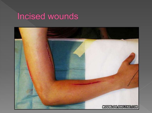 Incised wounds by Dr.M Balaji singh, ACSMCH, Chennai 2020 | PPTX ...