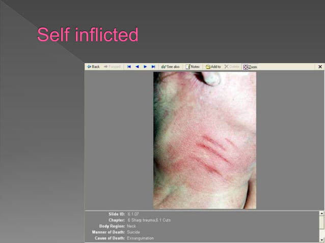 Incised wounds by Dr.M Balaji singh, ACSMCH, Chennai 2020 | PPTX ...