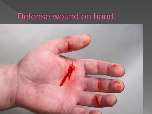 Incised wounds by Dr.M Balaji singh, ACSMCH, Chennai 2020 | PPTX ...