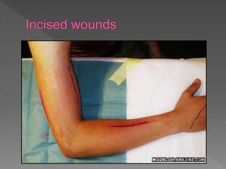 Incised Wound