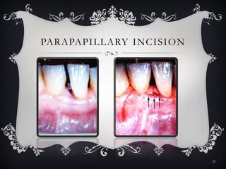incision.pdf