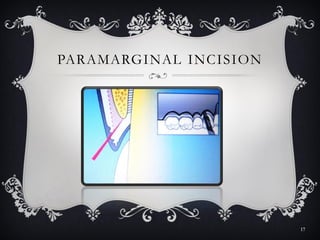 incision.pdf