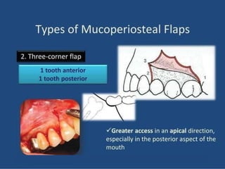 INCISION-FLAPSimplant lecture nom 2.pptx
