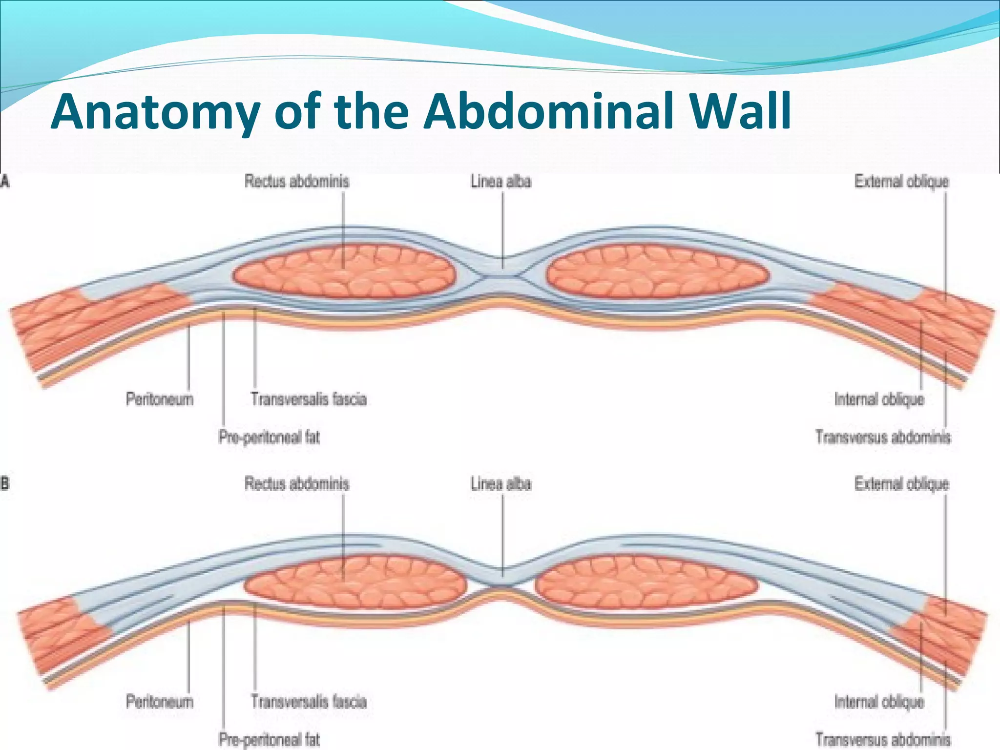 Types, Investigation, complication and treatment of Incisional hernia | PPT